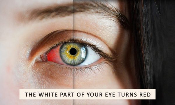 The-white-part-of-your-eye-turns-red