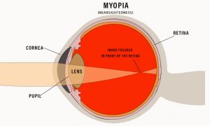 Myopia Causes Problems that Affect Your Life